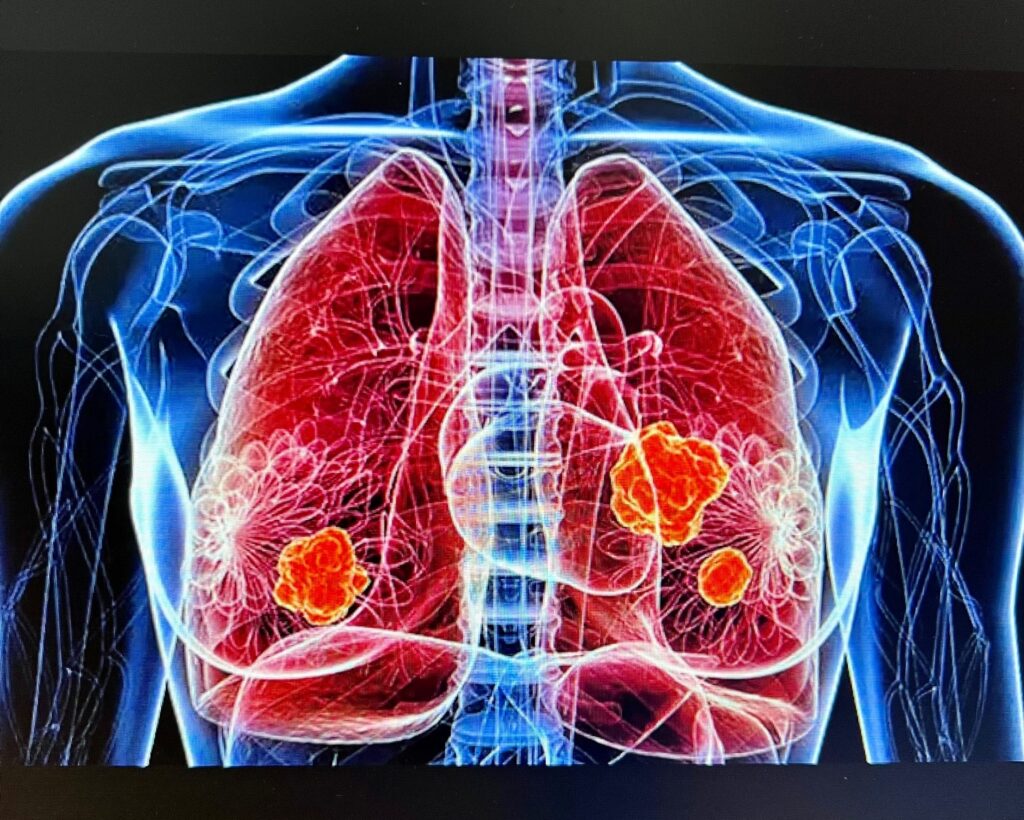 Biologic therapy for asthma - North Texas Allergy & Asthma Center