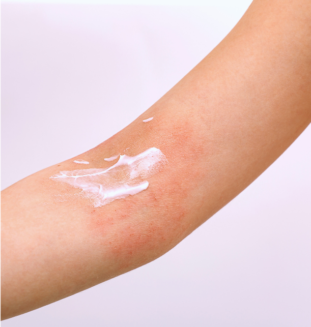 Atopic Dermatitis- Eczema: Symptoms, Causes, Allergy Testing ...